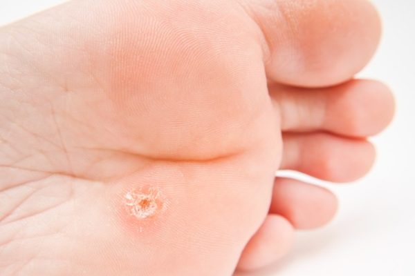 Can warts grow back? - DermCare Scannon Dermatology