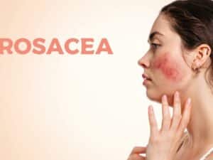 The 4 Types of Rosacea and How to Treat Them